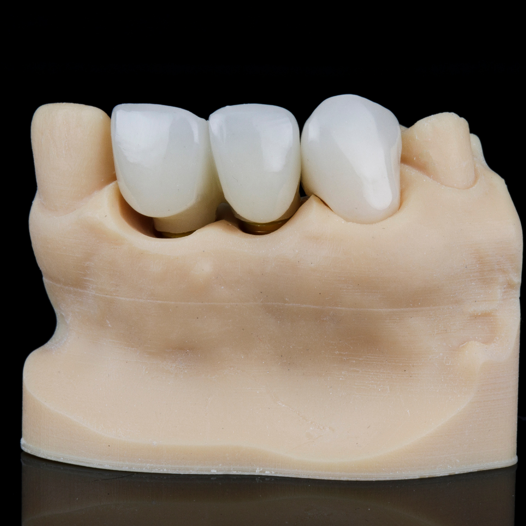 Dental Crowns Leicester | Restore Damaged Teeth Today